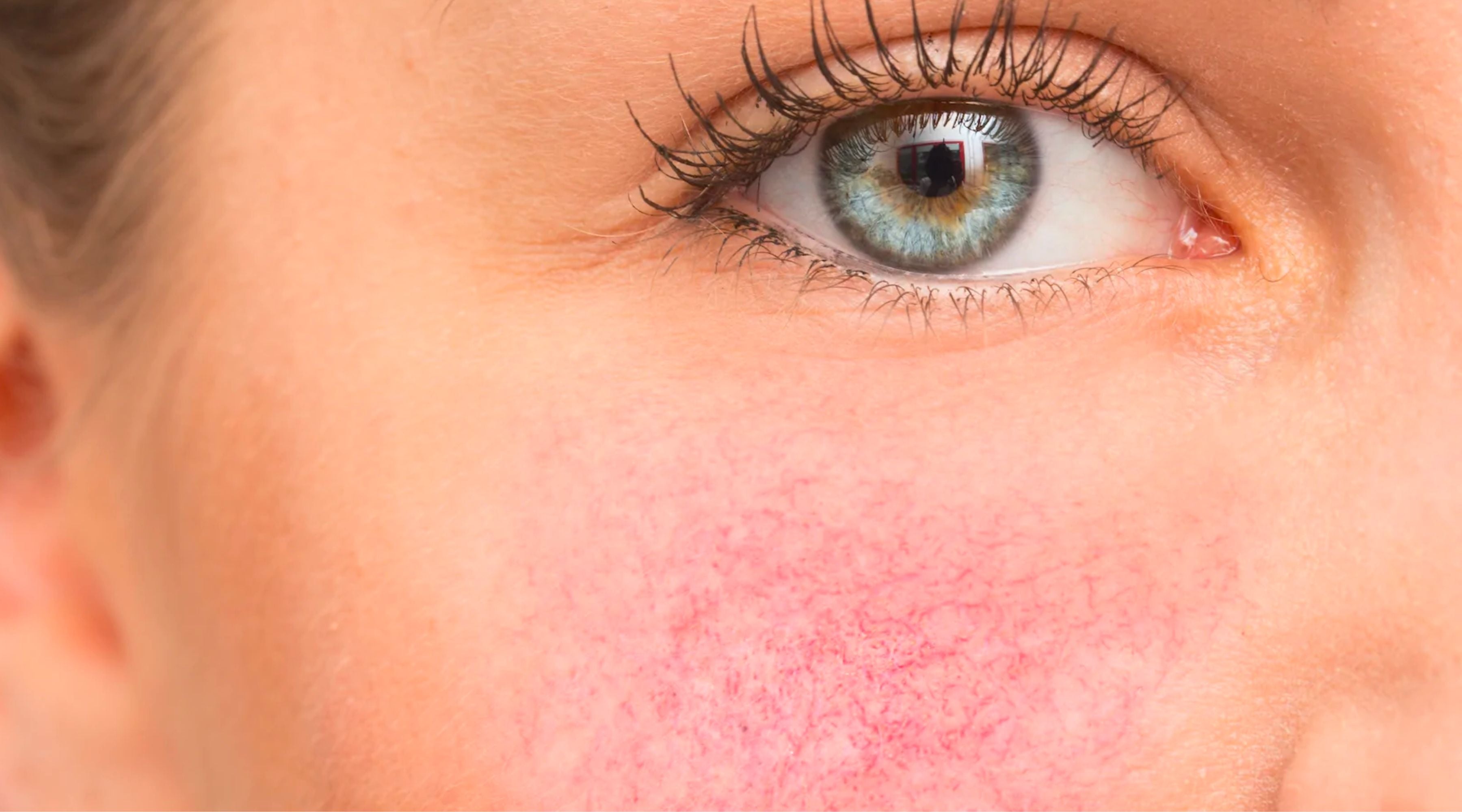 Rosacea On Cheeks Rosacea On Cheeks