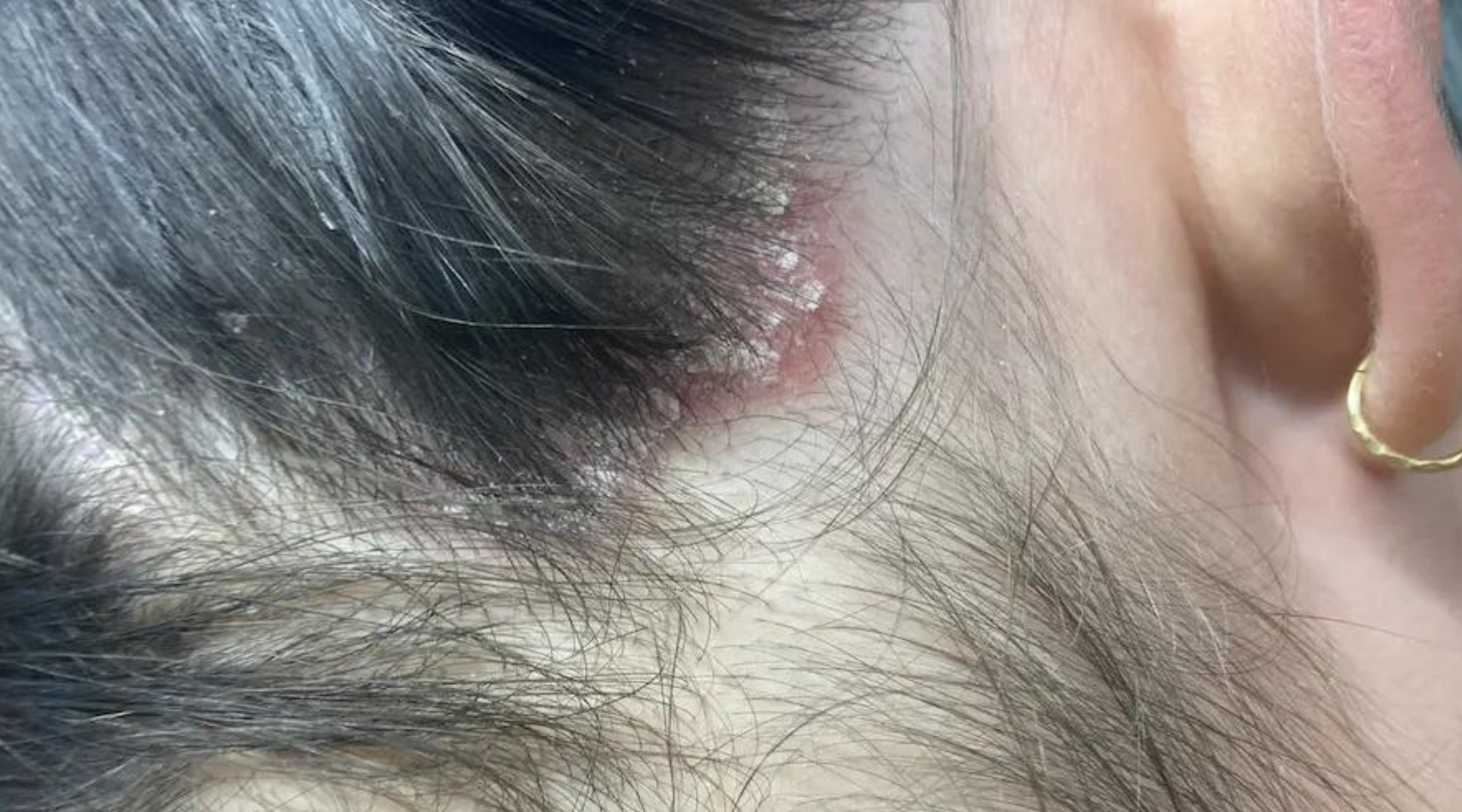 The ULTIMATE Guide to Scalp Psoriasis – Grahams Natural USA