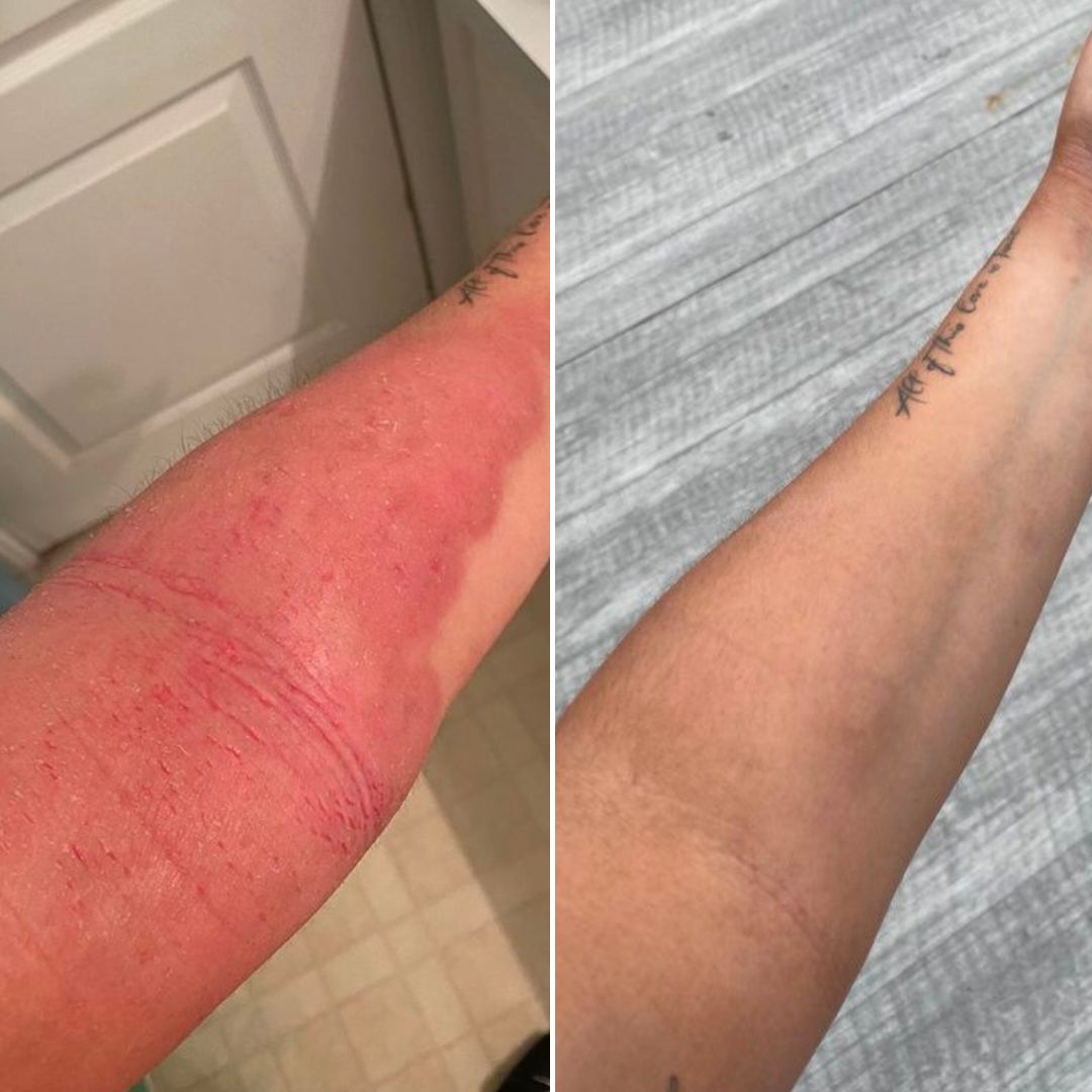 Grahams Natural Eczema Cream | Eczema, Psoriasis & Rosacea – Grahams ...