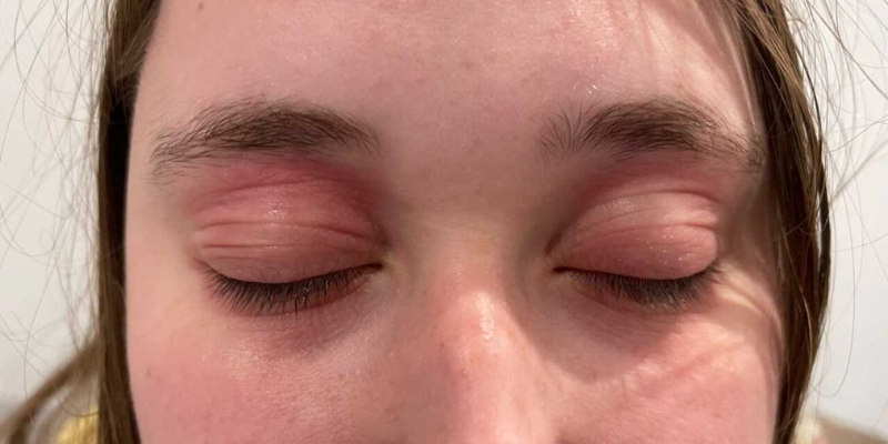 Grahams Natural Eczema Cream | Eczema, Psoriasis & Rosacea – Grahams ...